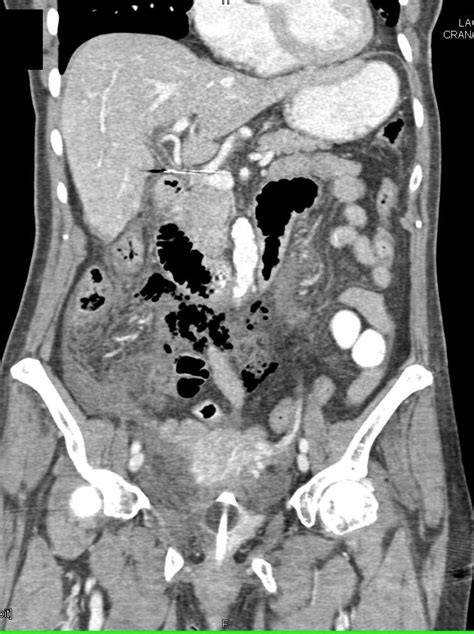 Perforated Small Bowel With Abscess Small Bowel Radiology Case
