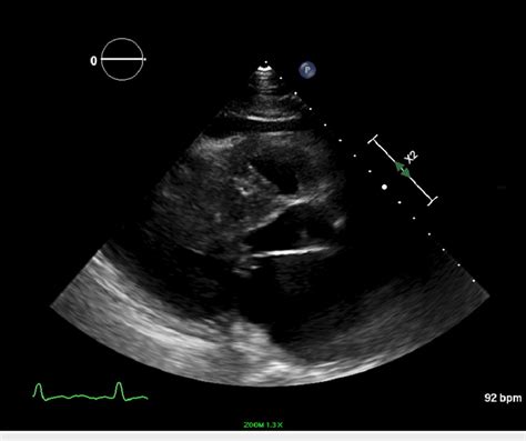 Tte Parasternal Long Axis View Tte Transthoracic Echocardiogram Download Scientific Diagram