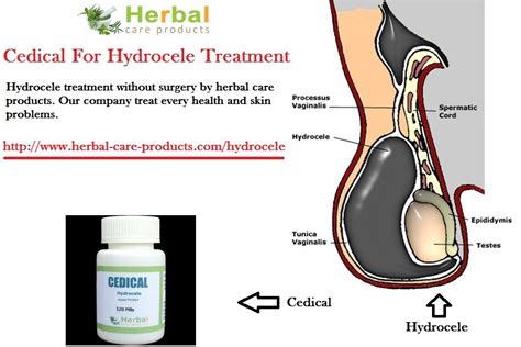 10 Natural Remedies For Hydrocele Herbal Care Products Herbalism Natural Remedies Treatment