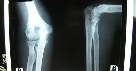 X Rays And Slides Ring Sequestrum After Elbow Traction