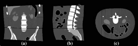 Figure 8 From A Bpf Fbp Tandem Algorithm For Image Reconstruction In