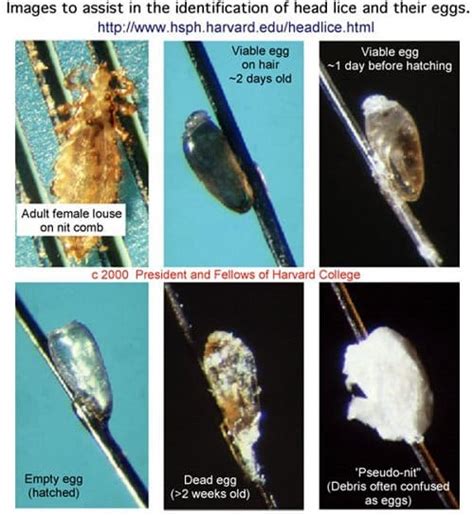 Can Lice Nits Survive In Extreme Temperatures Lice Nits