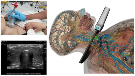 open source ultrasound trainer using 3dslicer success stories 3d