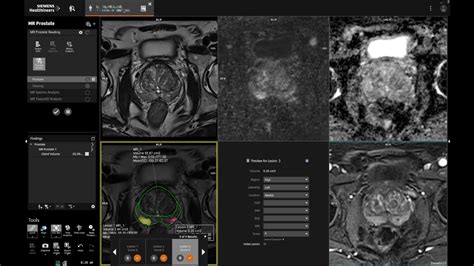 Mr Prostate Ai Based Segmentation And Classification
