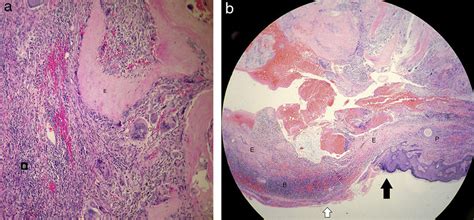 A Histopathology Shows Aggregate Of Basophilic Basaloid Cells B At Download Scientific