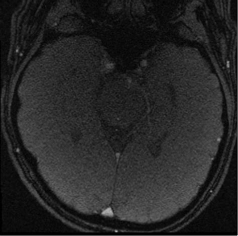 Cerebrospinal Fluid Flow MRI CSF Flow MRI Protocol And Planning