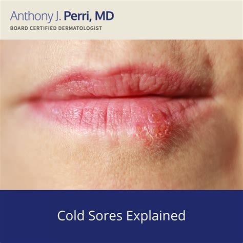 Difference Between Cold Sores And Ed Lips
