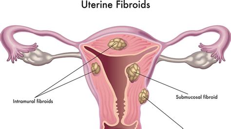 Understanding Subserosal Fibroids Causes Symptoms And Treatment
