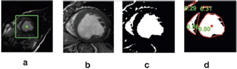 Automated Segmentation Of Left Ventricle In Cine Cardiac Mr Images Journal Of Cardiovascular