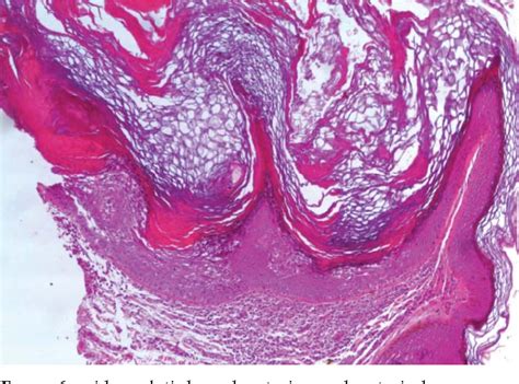 Figure 5 From Mosaic Epidermolytic Ichthyosis Case Report Semantic Scholar