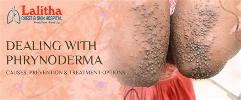 Phrynoderma Explained Causes Prevention And Treatments
