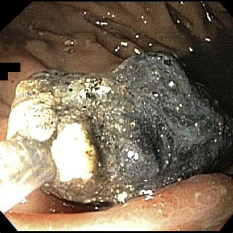 Removal Of Necrotic Debris During Necrosectomy Download Scientific