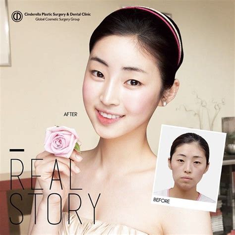 Cinderella Plastic Surgery Cinderellakorea • Instagram Photos And