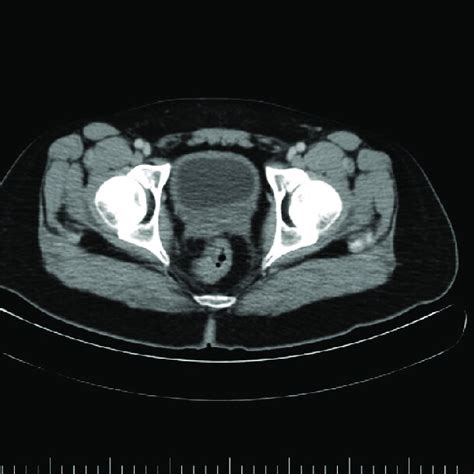 Post Treatment Axial Computed Tomography Image Showing Significant Download Scientific Diagram