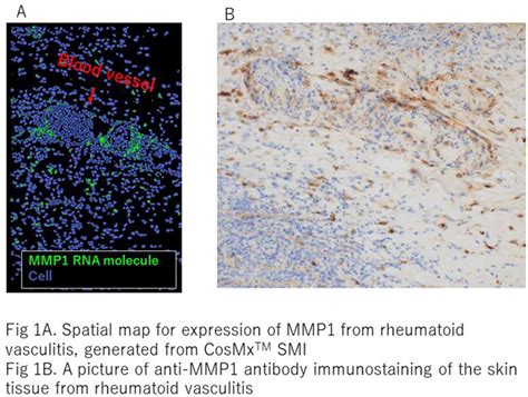 Ab0167 Single Cell Spatial Transcriptome Analysis Identifies Disease
