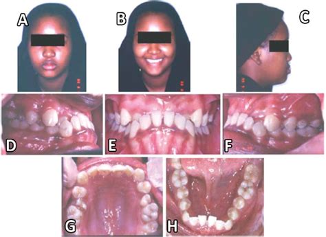 Pseudo Class Iii Malocclusion Saudi Medical Journal Pseudo Class Iii Malocclusion Saudi Medical Journal