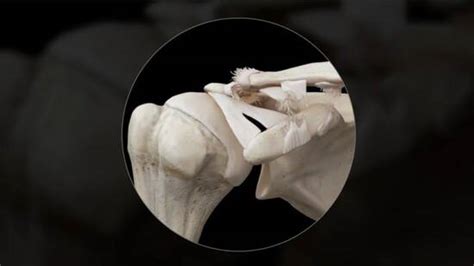 Shoulder Separation Overview Orthopedia Patient