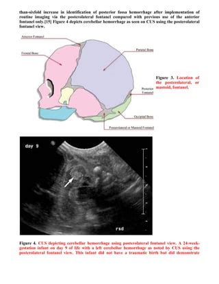 Topic Of The Month Cerebellar Hemorrhage In Extremely Low Birth