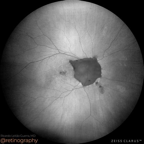 Myopic Macular Neovascularization Retinography