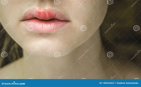 Symptom Of Herpes Zoster Shingles Royalty Free Stock Image
