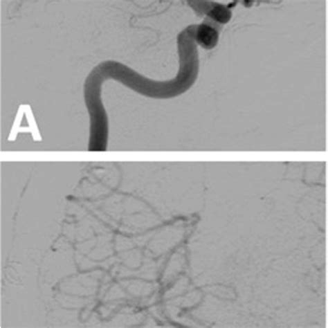 Preoperative Dsa A Showing A Giant Right Mca Bifurcation Aneurysm Download Scientific