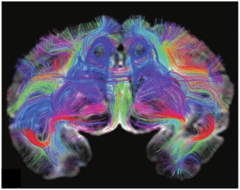 20 Diffusion Spectrum Imaging Coronal Cross Section Of The Fibers