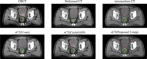 An Example Cbct Axial Slice Whose Bladder And Rectum Varied Download Scientific Diagram