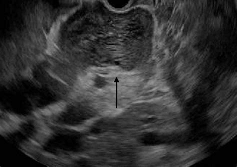 Endoscopic Ultrasound Image Of A Dilated Common Bile Duct With Mucin Download Scientific
