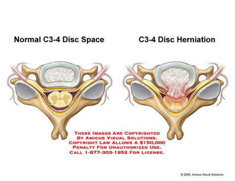 C3 4 Disc Herniation