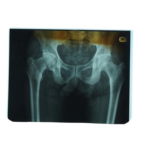 X Ray Pelvis Film Medical