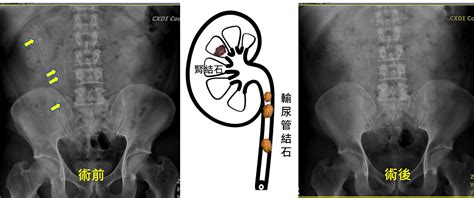 黃韋銘醫師 軟式輸尿管鏡碎石術 個案分享