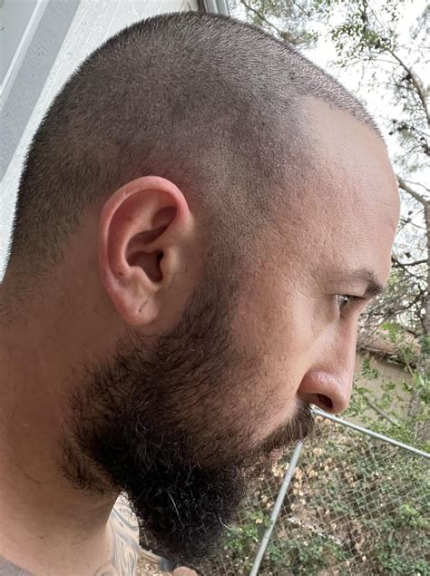 Progress Photos Hmr 35 Month Update Rhairtransplants