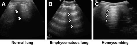 Figure 2 From The Reliability Of Lung Ultrasound In Assessment Of
