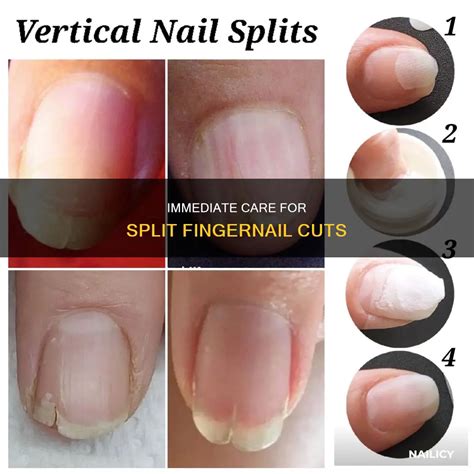 Immediate Care For Split Fingernail Cuts Nailicy