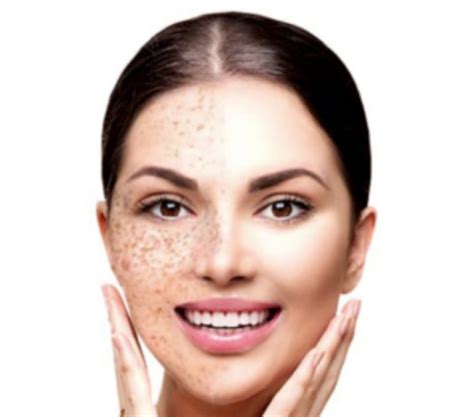 기미잡티 제거 피부 토닝 종류 및 가격 피코토닝 10회 후기 네이버 블로그