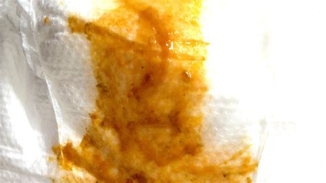 Yellow Colored Stool In Adults