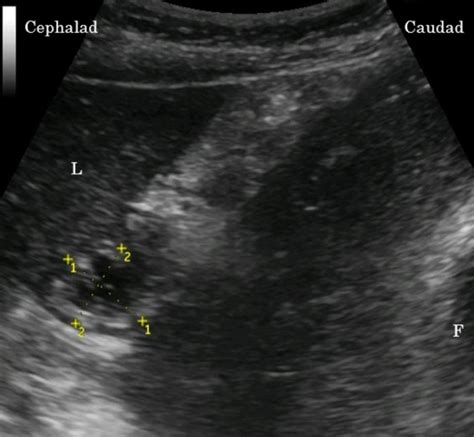 Ultrasonographic Image Of The Gastric Antrum The Figure Demonstrates