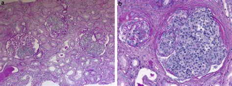 Ab Light Microscopy Shows Occlusion Of Glomerular Capillary Loops
