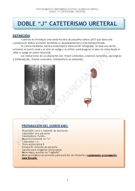 Doble J Doble J” Cateterismo Ureteral DefiniciÓn Consiste