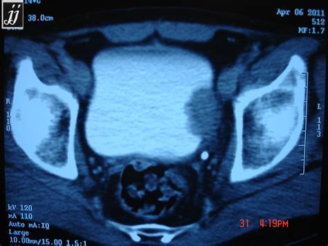 Abdomen Urinary Bladder Tumor Radioogle