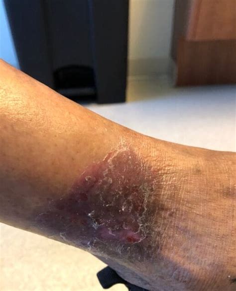 Lower Leg Ulcers Dermatology Advisor