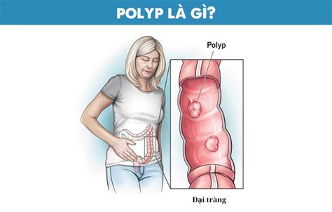 Polyp LÀ GÌ Polyp CÓ PhẢi Ung ThƯ KhÔng