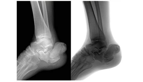 Low Dose Digital Radiography The Meaning Of Ldr Digital