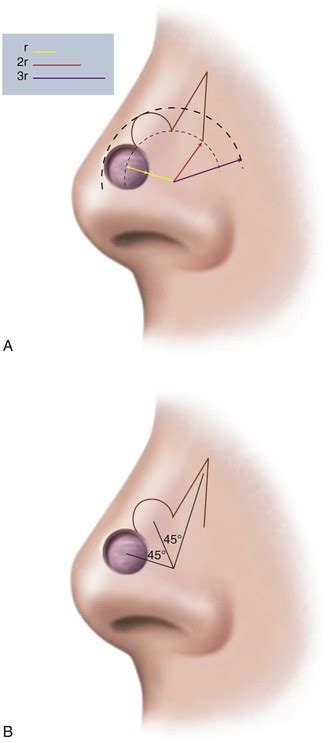 Bilobe Flaps Clinical Gateclinical Gate