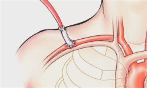 Type A Acute Aortic Dissection Still Carries High Mortality Risk In