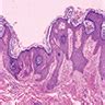Pathology Outlines Epidermal Nevus
