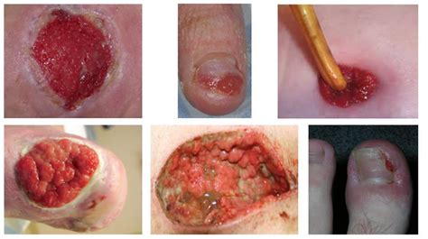 Hypergranulation Wounds Africa