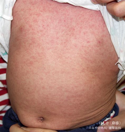 はしか（麻疹） ｜ 写真で見る「子どもの病気」 みやけ内科・循環器科【総合内科のアプローチ】