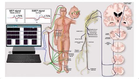 Does 1ml Bolus Of Propofol Cause 50 Amplitude Drop In Cortical Ssep