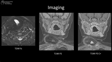 17 Month Old Female With Palpable Neck Mass American Society Of